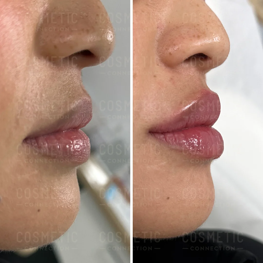 Get Natural-Looking Lip Filler in London | Dermdoc