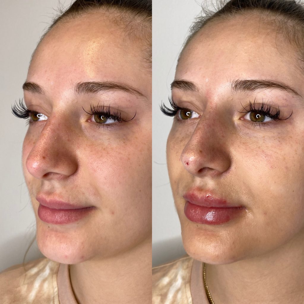Non-Surgical Nose Slimming Treatment in London | Dermdoc