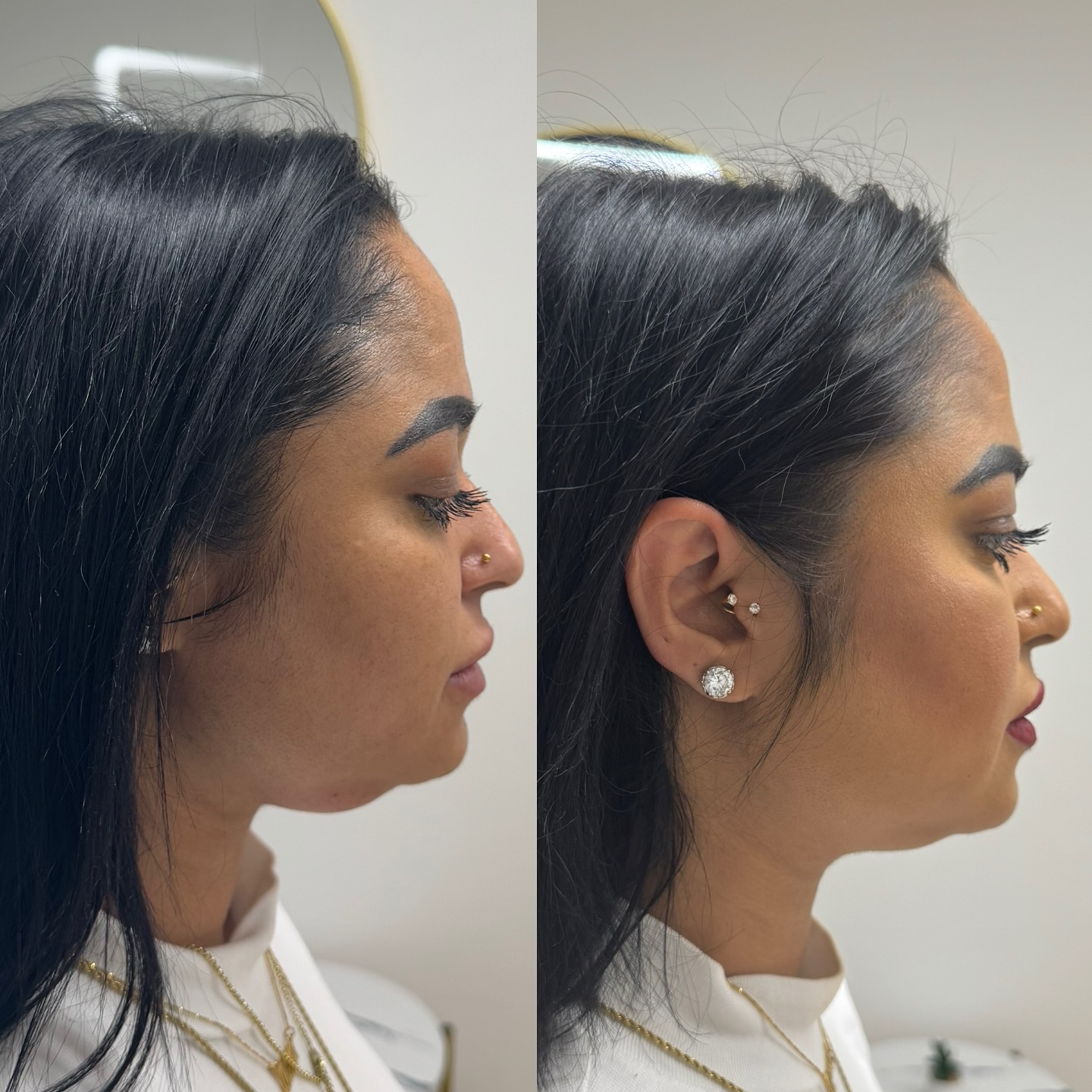Glowing Double Chin Reduction Treatment in London | Dermdoc